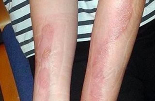 Salt and Ice Challenge : défi dangereux des adolescents