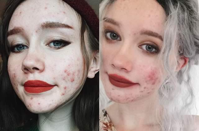 Compte Instagram qui montre acné et partage des messages d'espoir