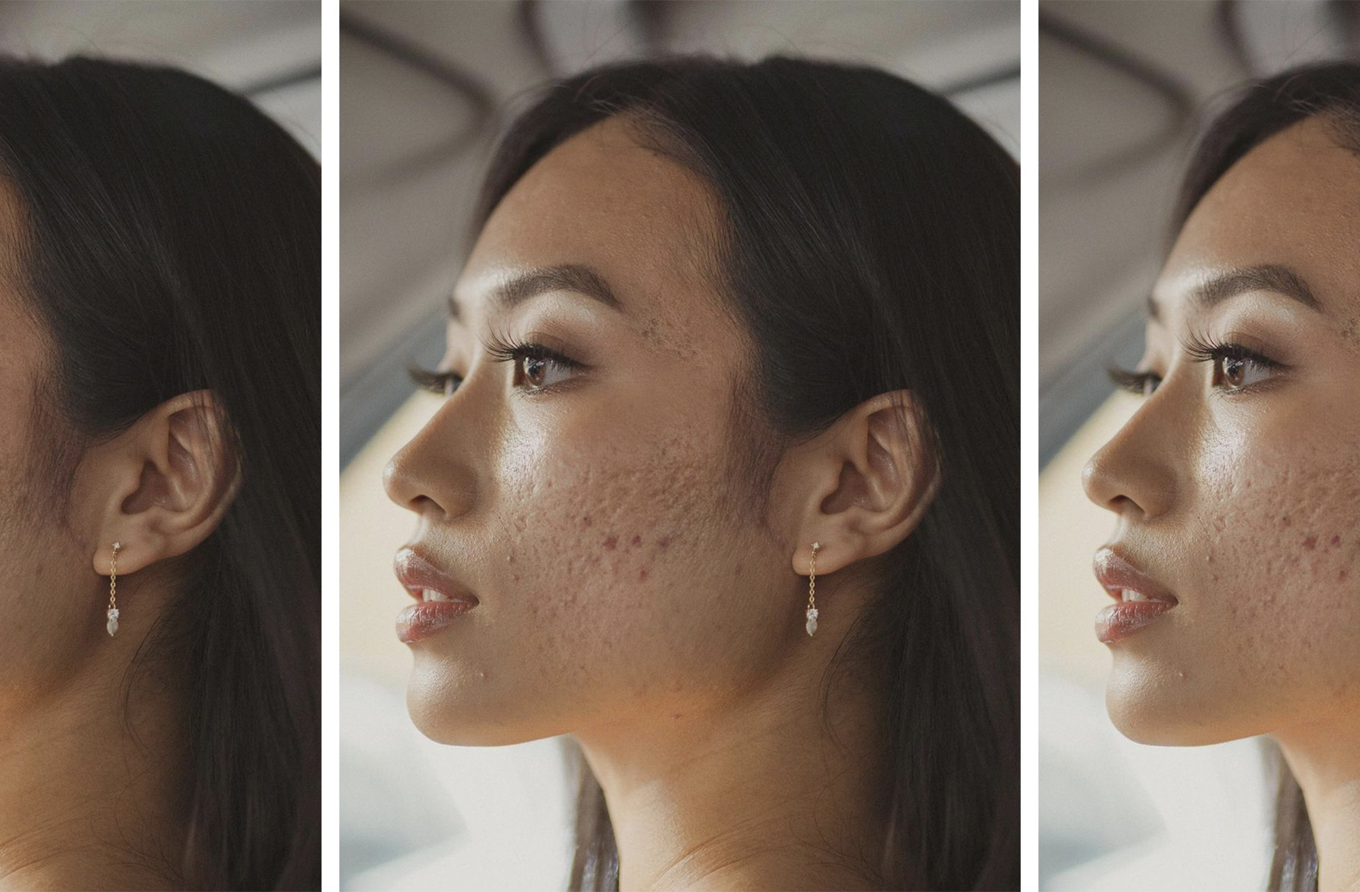 Ces différents traitements permettent d’estomper les cicatrices d’acné ...